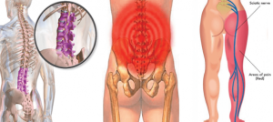 Sciatica Pain Treatment in Dwarka